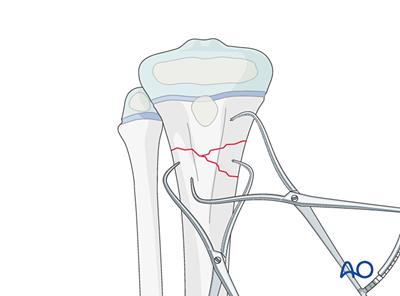 Open reduction - Plate fixation for Complete metaphyseal and greenstick ...