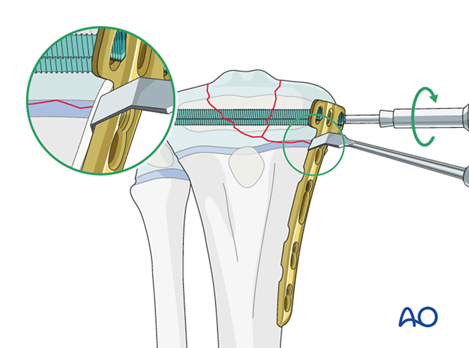 Open reduction - Plate fixation for Epiphyseal and epi-metaphyseal ...