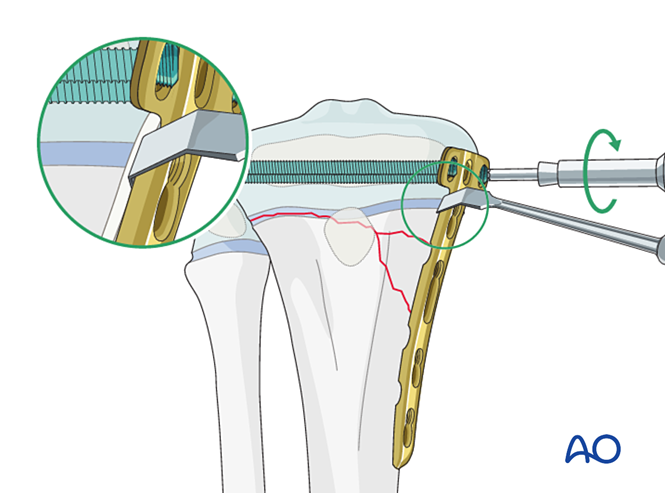 Open reduction - Plate fixation for Epiphysiolysis with metaphyseal ...