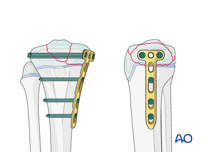 Open reduction - Plate fixation for Epiphyseal and epi-metaphyseal ...