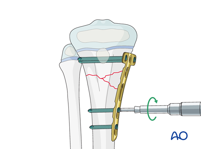 Open reduction - Plate fixation for Complete metaphyseal and greenstick ...