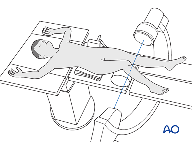 Patient preparation in supine position