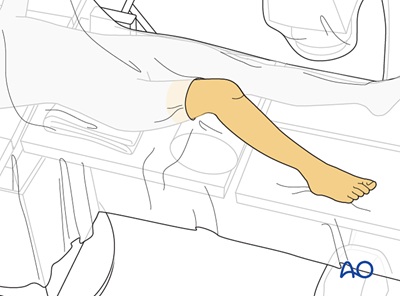 Patient preparation in supine position