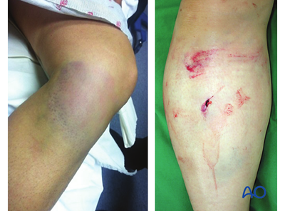 All further reading to the pediatric proximal tibia