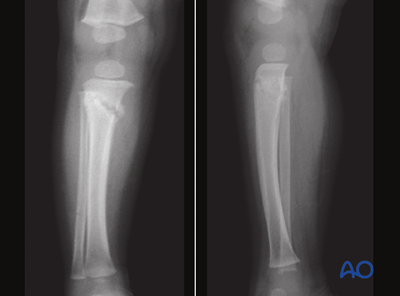Complete metaphyseal and greenstick fracture