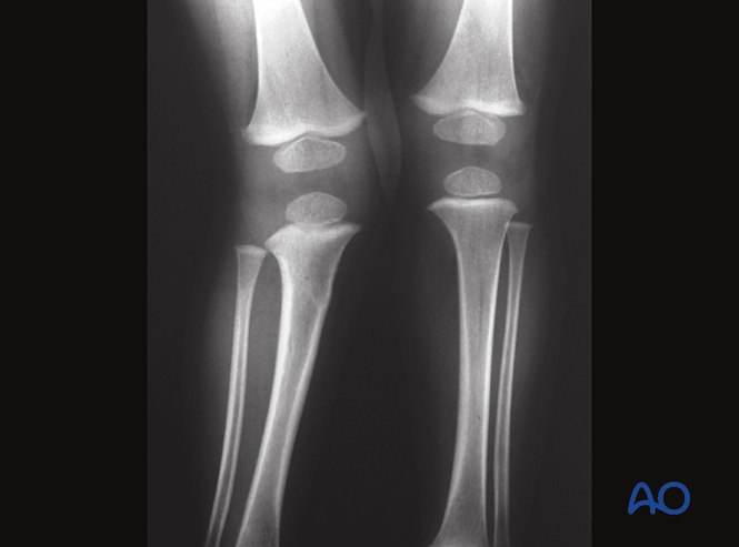 Complete metaphyseal and greenstick fracture