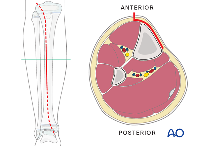 All approaches to the pediatric tibial shaft