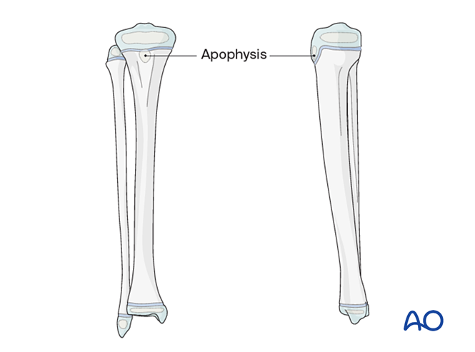 Approach to the anteromedial tibial surface