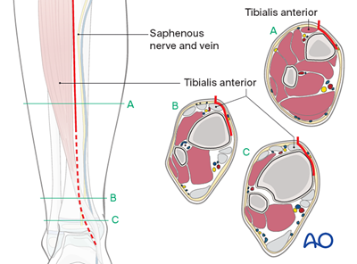Approach to the anteromedial tibial surface