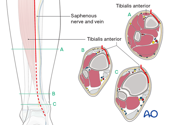 Approach to the anteromedial tibial surface