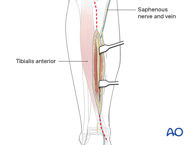 Approach to the anteromedial tibial surface
