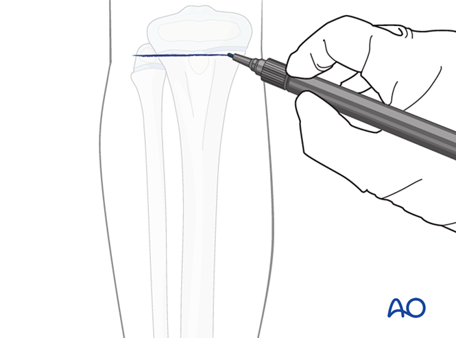 Minimally invasive medial approach to the tibia