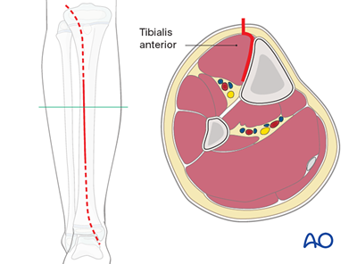 Approach to the anterolateral tibial surface