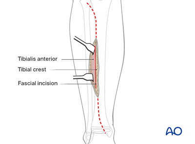 Approach to the anterolateral tibial surface