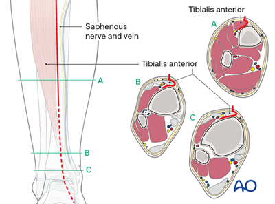 Approach to the anterolateral tibial surface