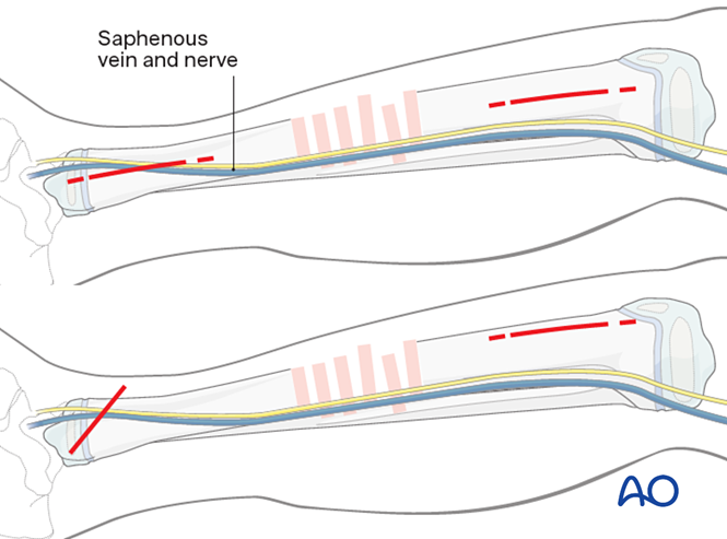 Minimally invasive medial approach to the tibia