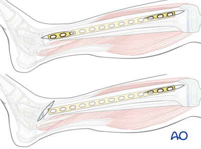 Minimally invasive medial approach to the tibia