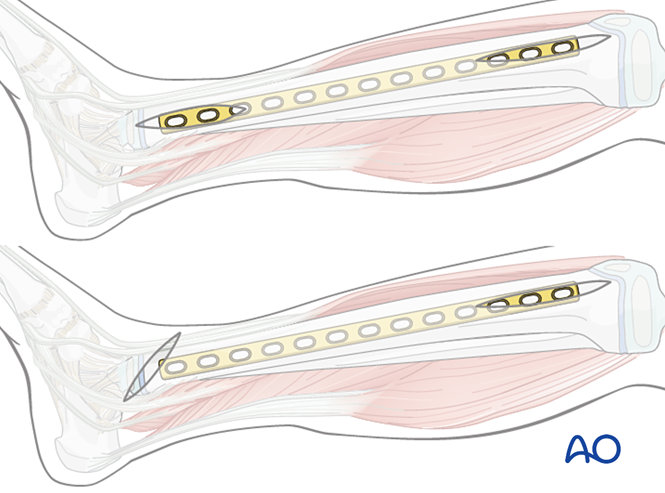 Minimally invasive medial approach to the tibia