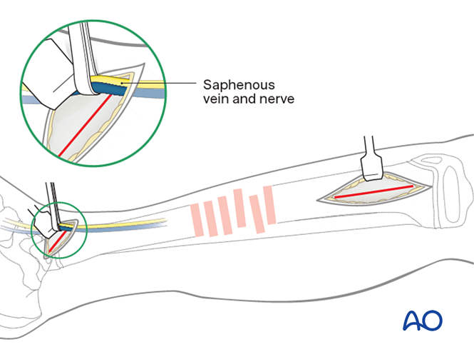 Minimally invasive medial approach to the tibia