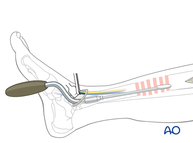 Mipo For Multifragmentary Tibial Fracture
