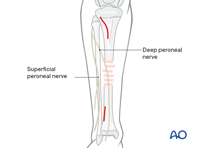 Minimally invasive lateral approach to the tibia