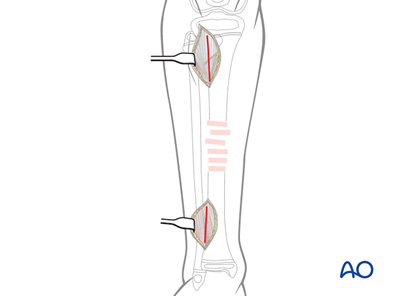 Minimally invasive lateral approach to the tibia