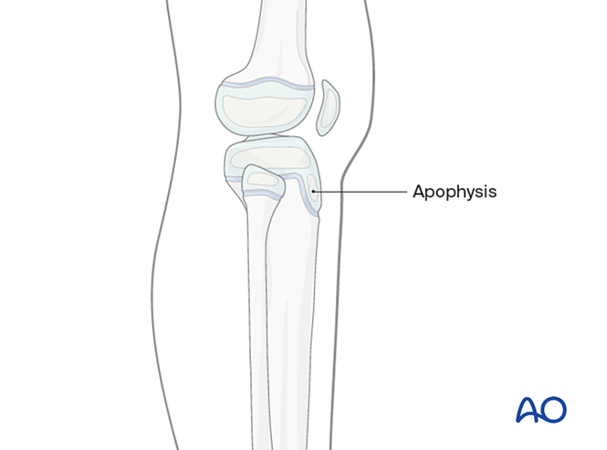 Minimally invasive lateral approach to the tibia