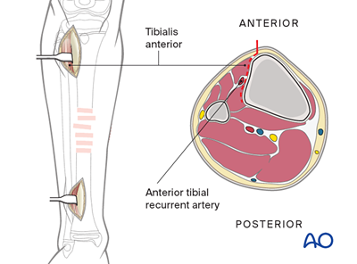 Minimally invasive lateral approach to the tibia