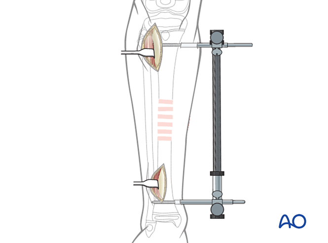 Minimally invasive lateral approach to the tibia