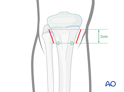 Elastic nailing for Simple transverse tibial fracture
