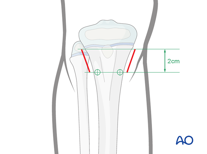 All approaches to the pediatric tibial shaft