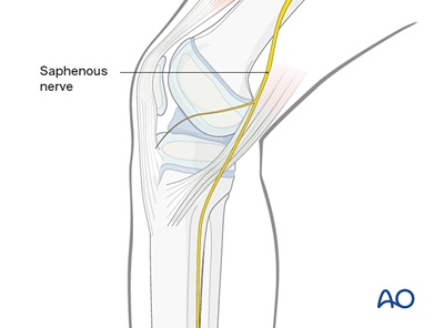 Safe zones for pin placement in the pediatric tibia