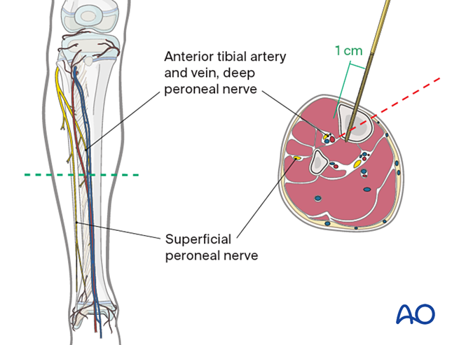 Safe zones for pin placement in the pediatric tibia