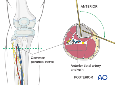 Safe zones for pin placement in the pediatric tibia