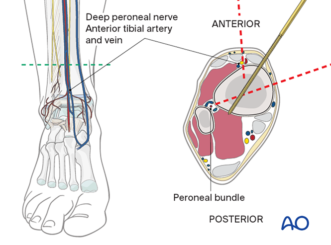 Safe zones for pin placement in the pediatric tibia