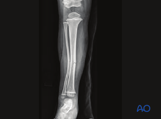 Greenstick fracture of the tibia
