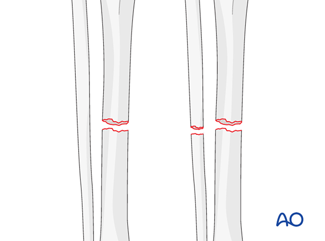 Simple transverse tibial fracture