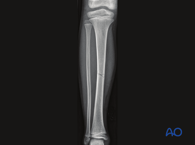 Simple transverse tibial fracture