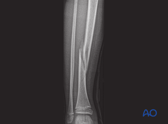 Simple oblique or spiral tibial fracture