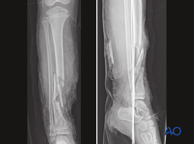 Multifragmentary tibial fracture