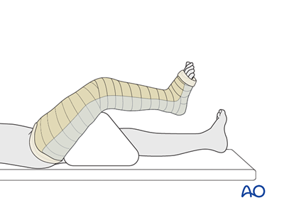 Closed reduction - Casting for Simple oblique or spiral tibial fracture