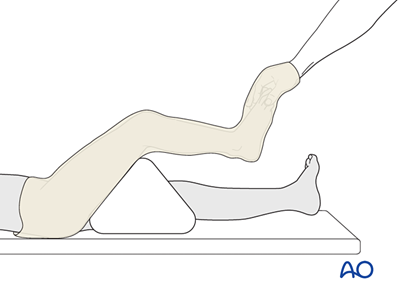 Nonoperative treatment - Long leg cast for Multifragmentary tibial fracture