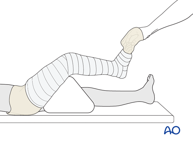 Nonoperative treatment - Long leg cast for Multifragmentary tibial fracture