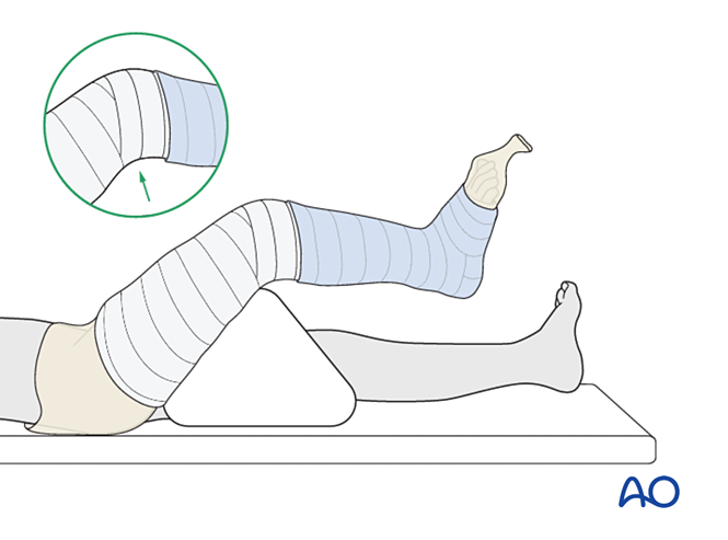 Closed reduction - Casting for Simple oblique or spiral tibial fracture