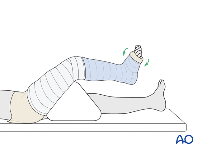 Closed reduction - Casting for Simple oblique or spiral tibial fracture