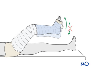 Nonoperative treatment - Long leg cast for Simple oblique or spiral ...