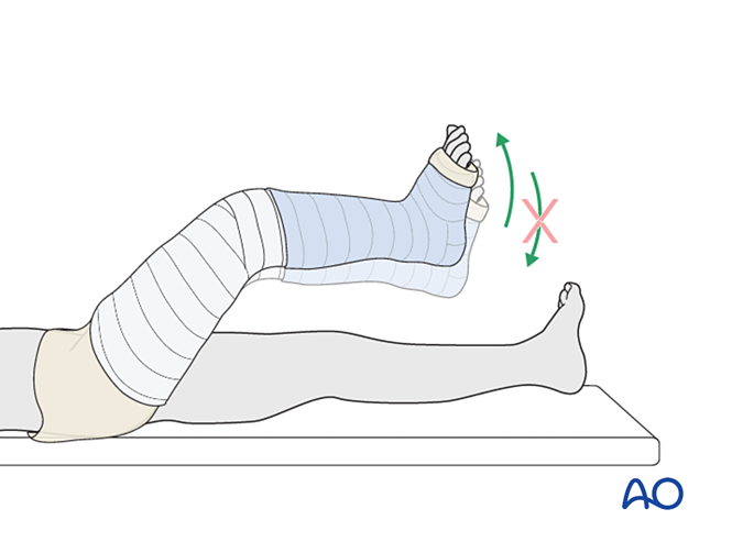 Closed reduction - Casting for Simple oblique or spiral tibial fracture