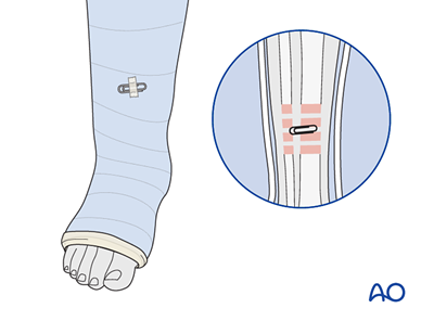 Nonoperative treatment - Long leg cast for Multifragmentary tibial fracture