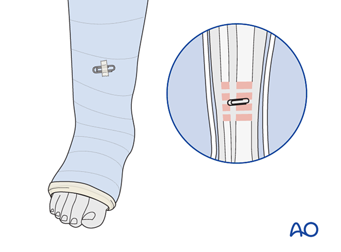 Nonoperative treatment - Long leg cast for Simple oblique or spiral ...