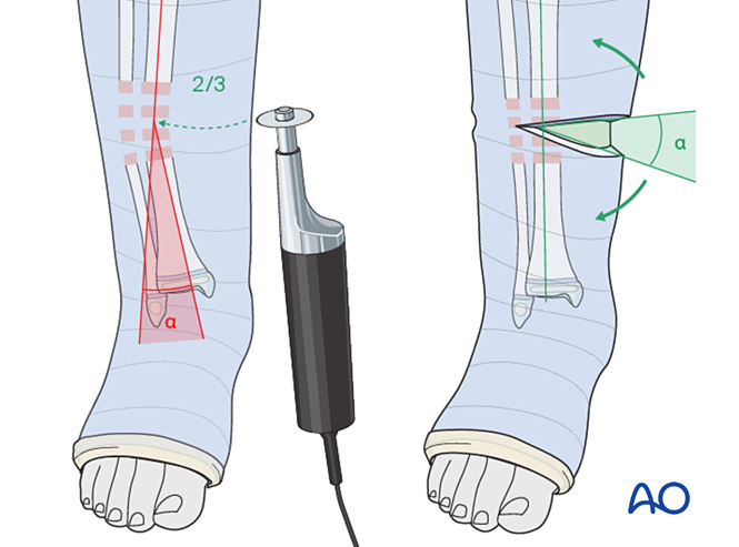 Closed reduction - Casting for Simple oblique or spiral tibial fracture